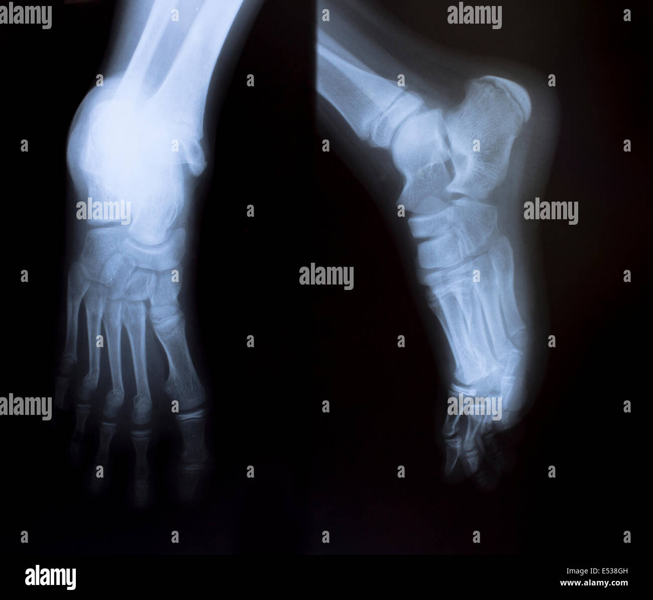 X-Ray Image Of Human Chest for a medical diagnosis Stock Photo - Alamy