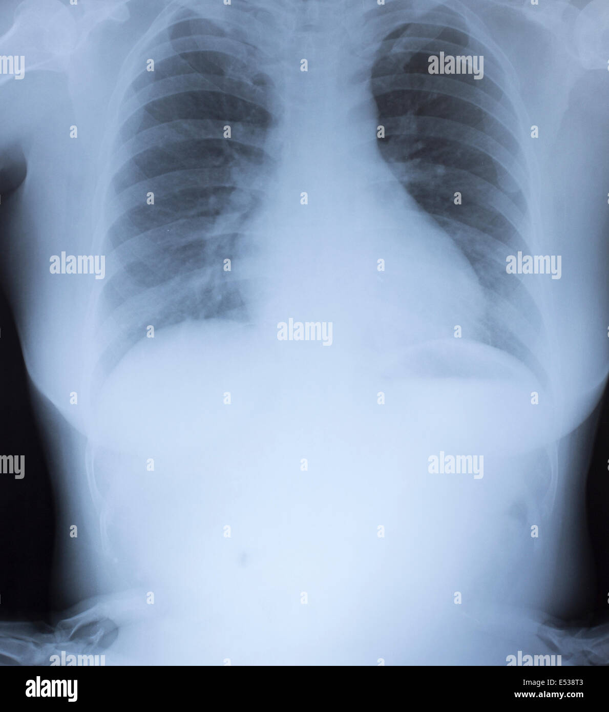 X-Ray Image Of Human Chest for a medical diagnosis Stock Photo - Alamy