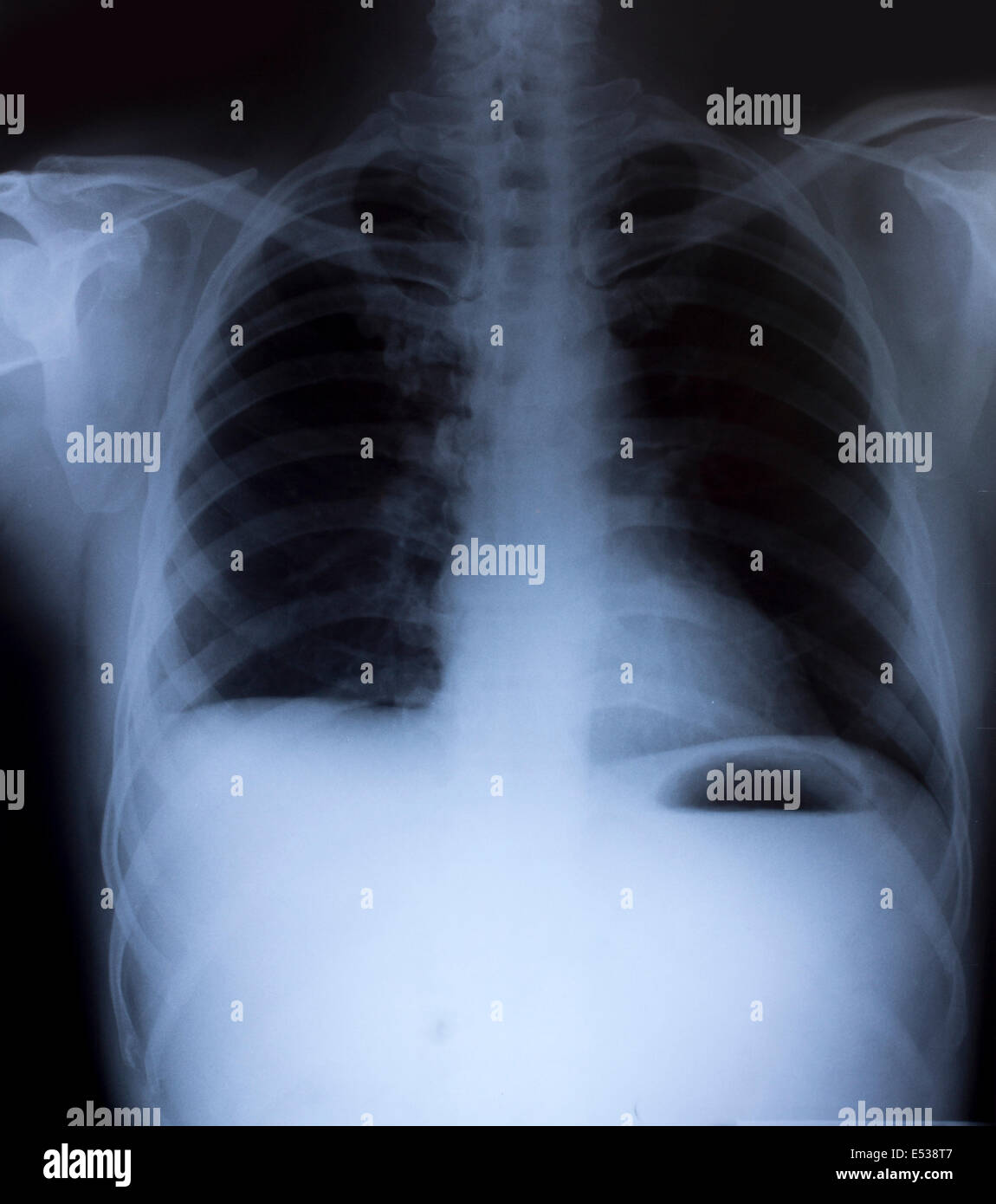 X-Ray Image Of Human Chest for a medical diagnosis Stock Photo - Alamy