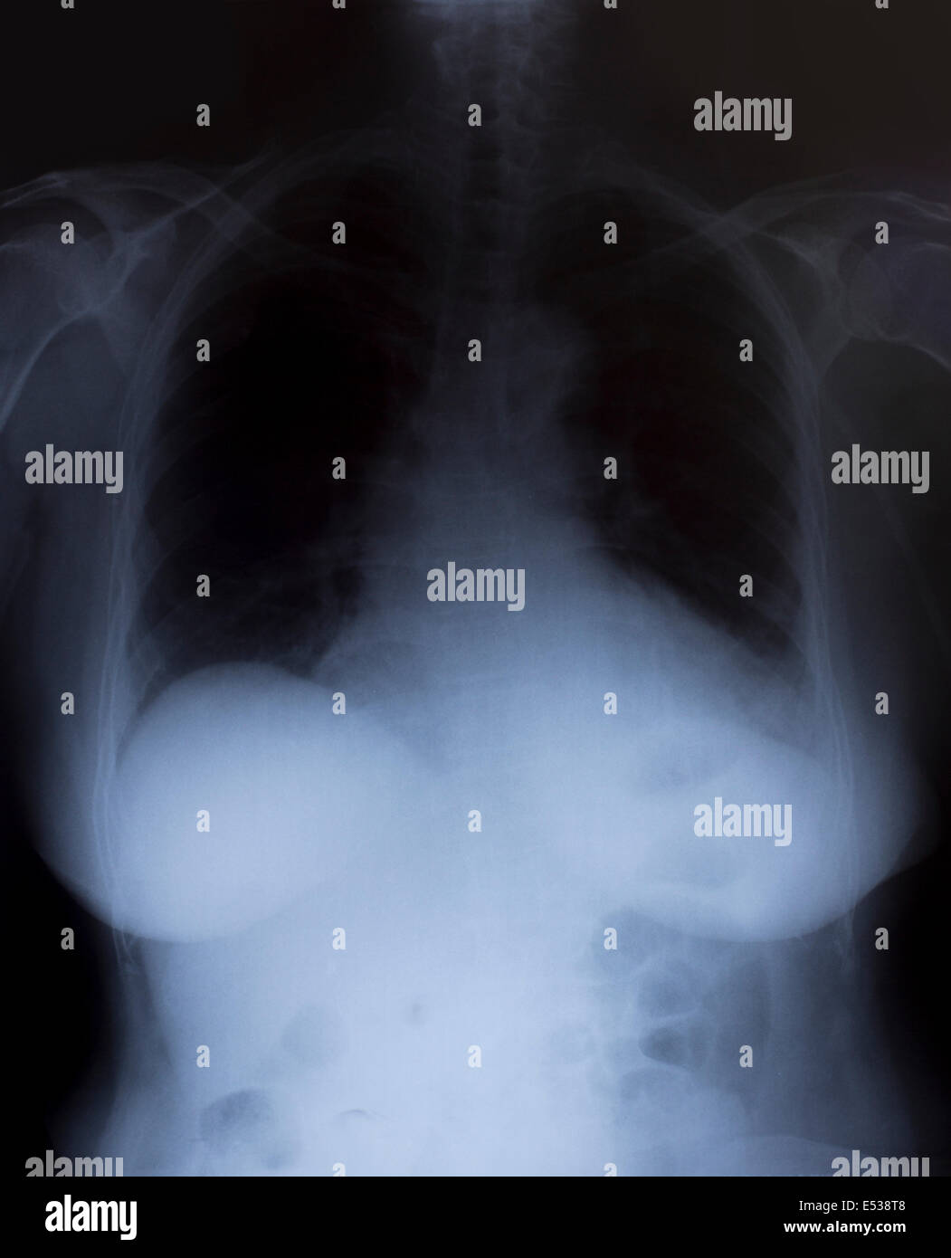 X-Ray Image Of Human Chest for a medical diagnosis Stock Photo - Alamy