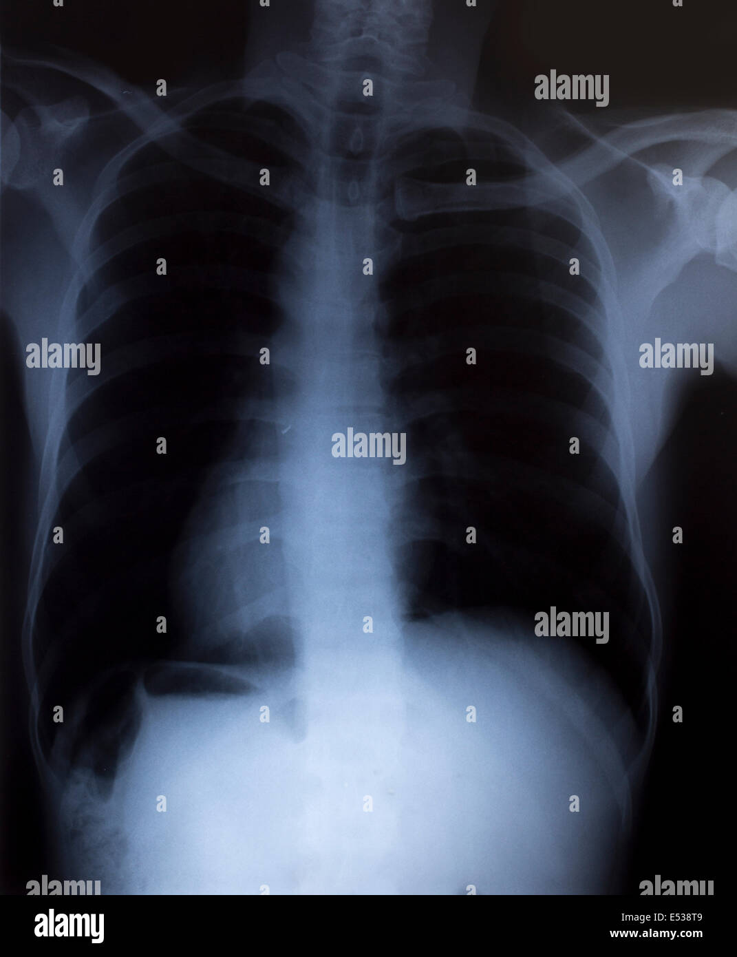 X-Ray Image Of Human Chest for a medical diagnosis Stock Photo - Alamy