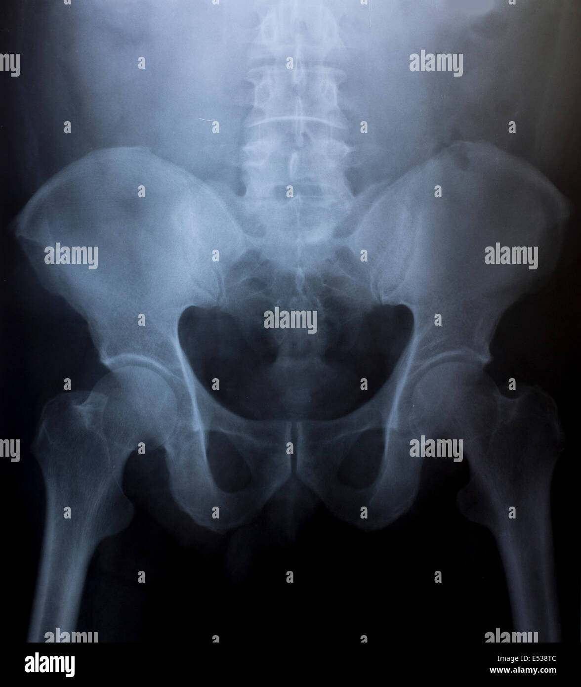 X-Ray Image Of Human Chest for a medical diagnosis Stock Photo - Alamy