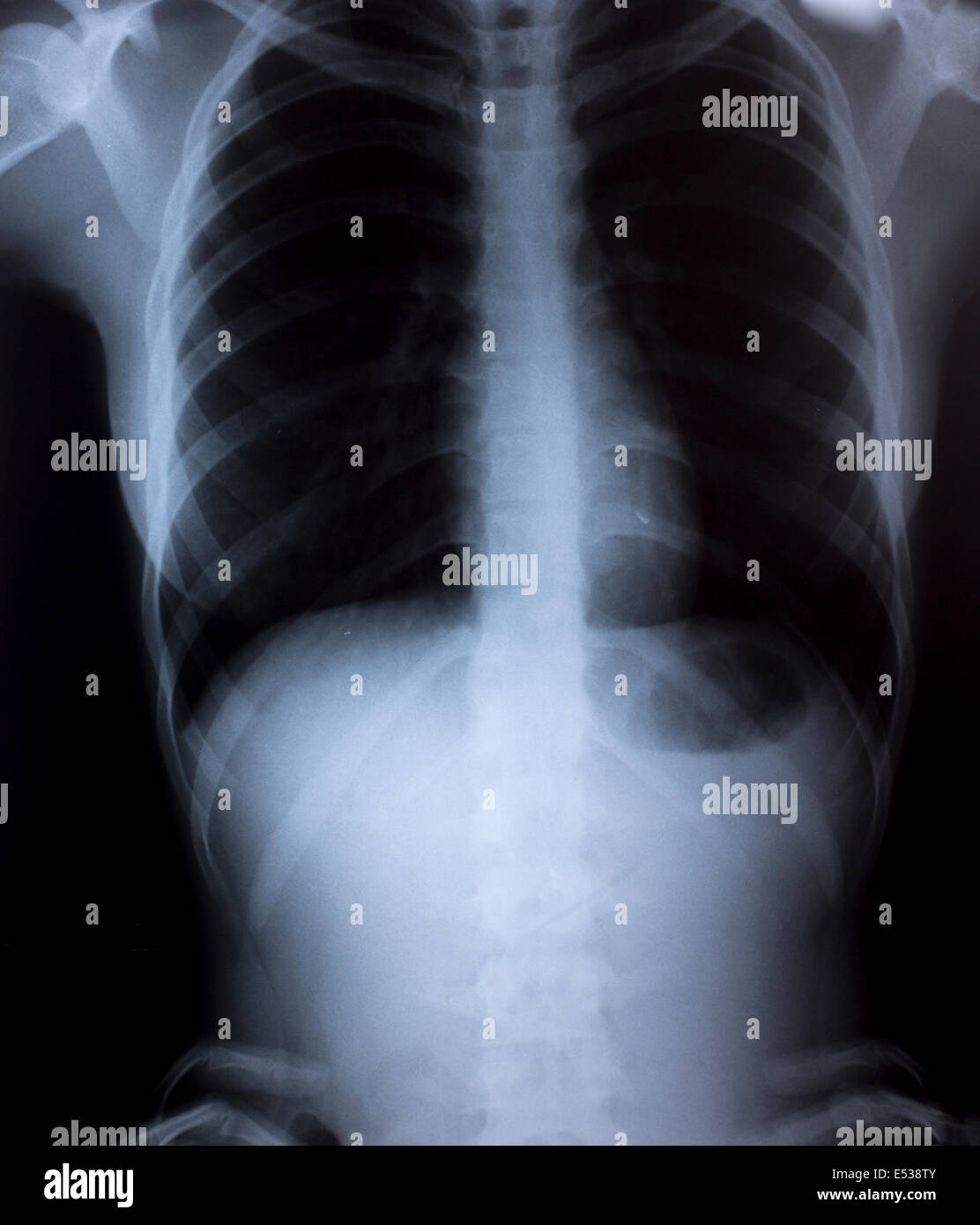 X-Ray Image Of Human Chest for a medical diagnosis Stock Photo - Alamy