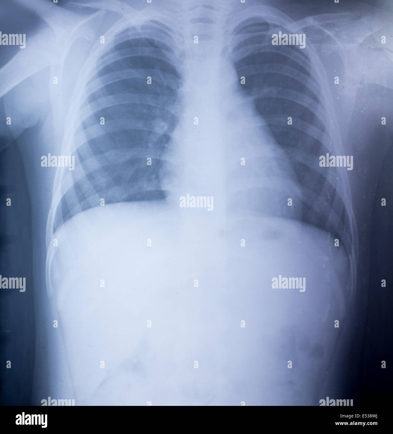X-Ray Image Of Human Chest for a medical diagnosis Stock Photo - Alamy