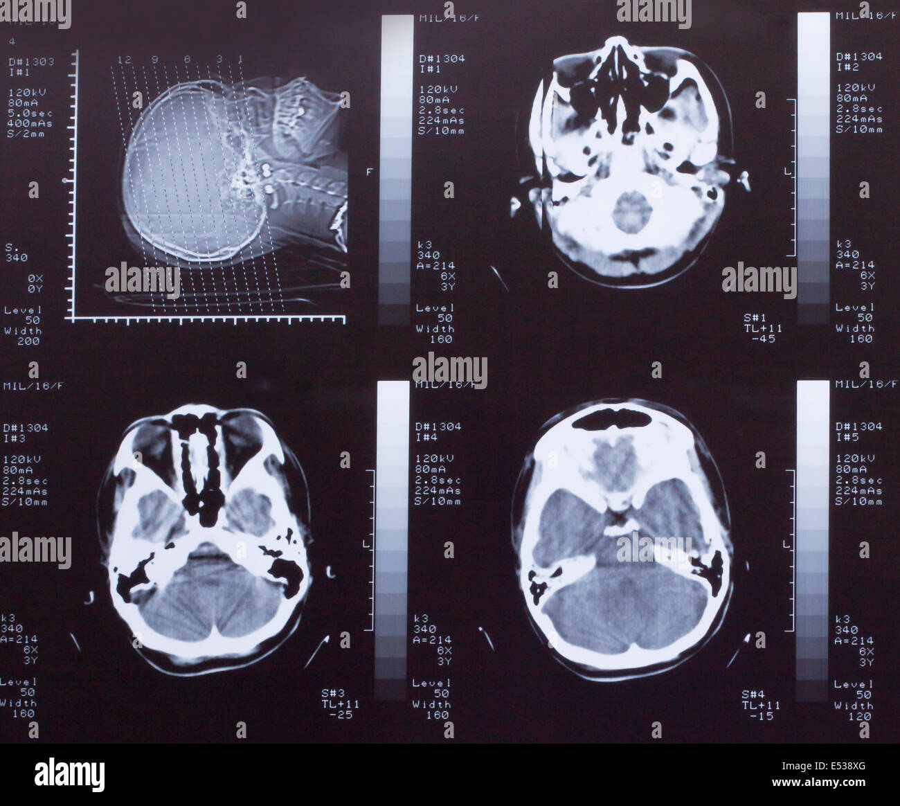 Photograph of the brain section hi-res stock photography and images - Alamy