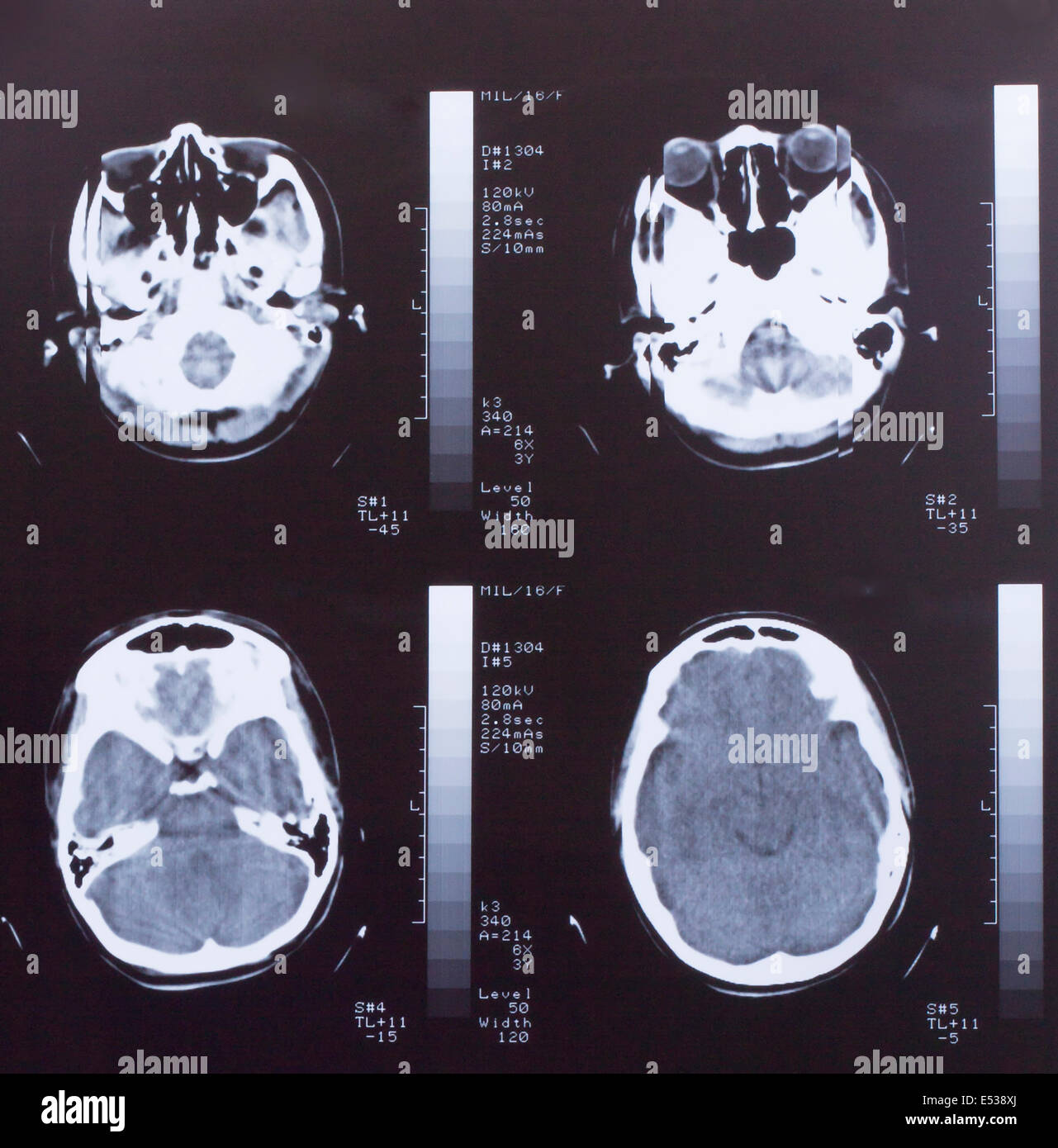 Ct Scan Brain Cancer Stock Photos & Ct Scan Brain Cancer Stock Images ...