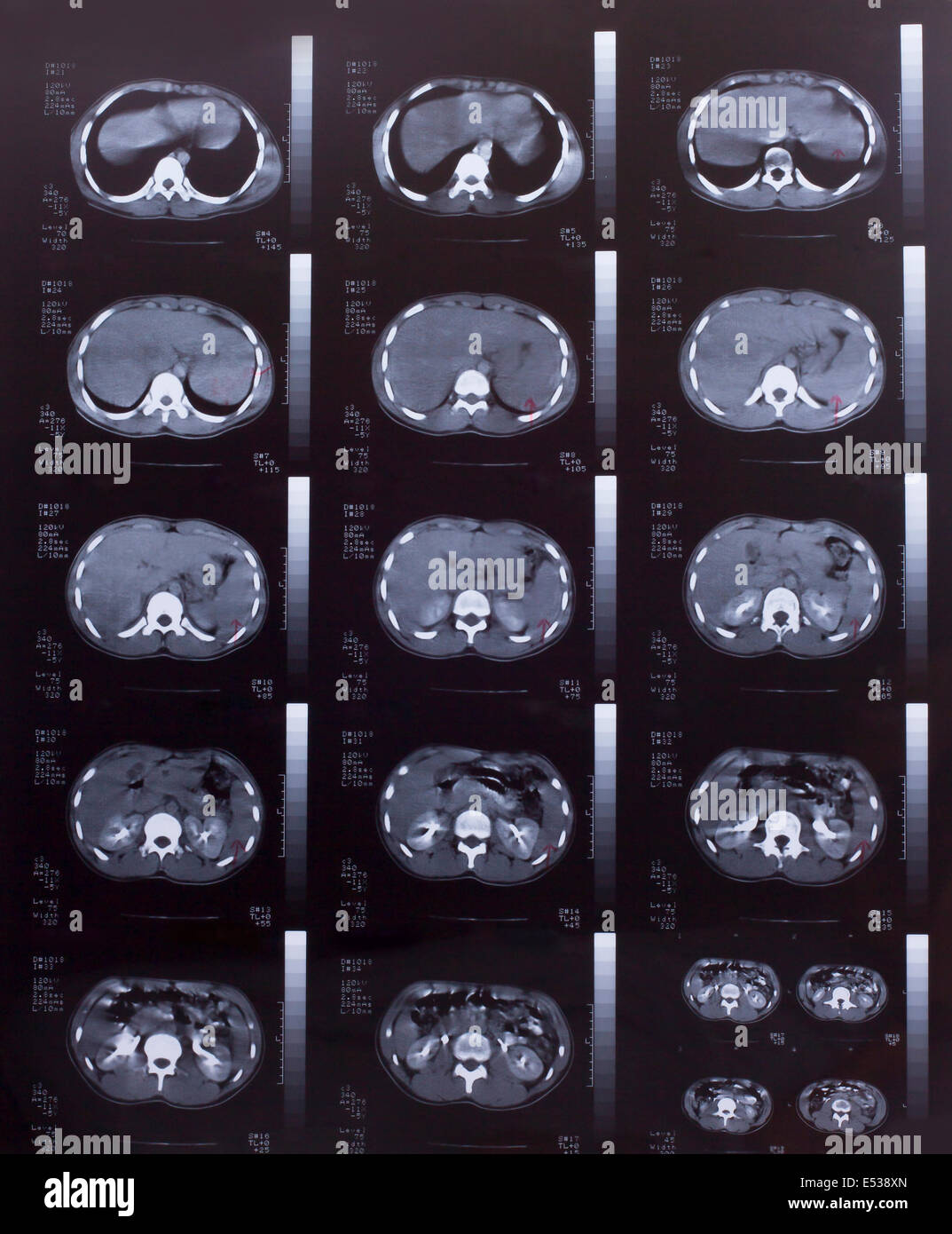 Closeup of a CT scan with chest and abdomen Stock Photo - Alamy