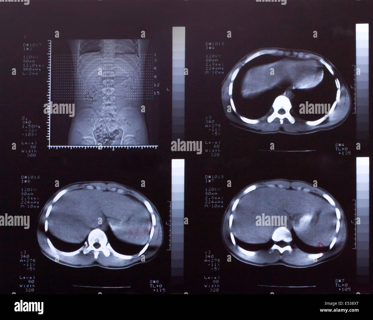 Ct Scan Abdomen High Resolution Stock Photography and Images - Alamy