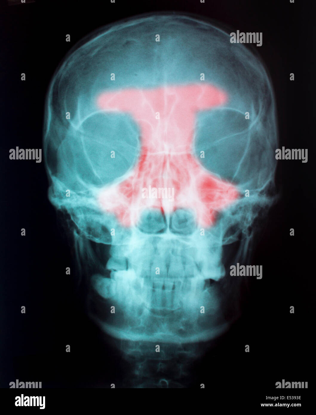 Sinus x ray hi-res stock photography and images - Alamy
