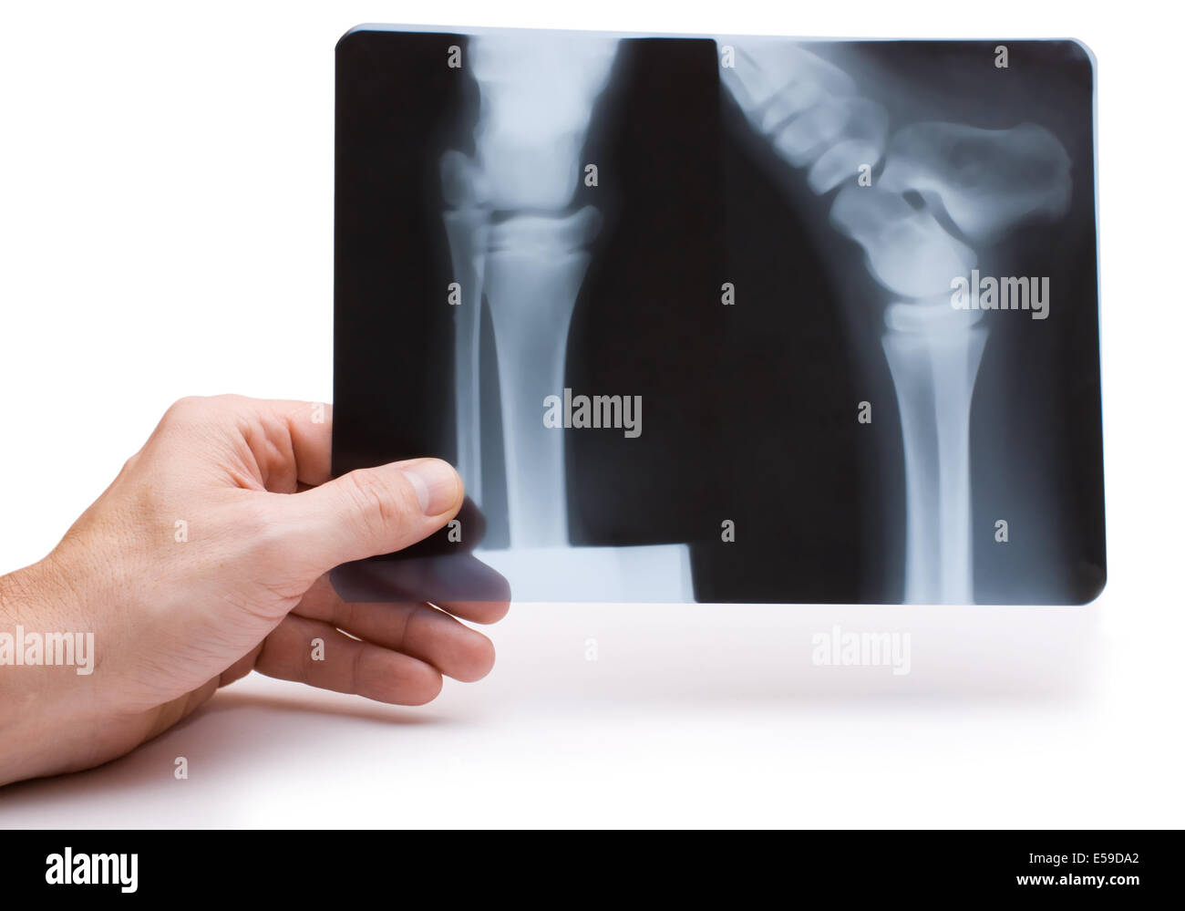 X ray radiograph hand hi-res stock photography and images - Alamy