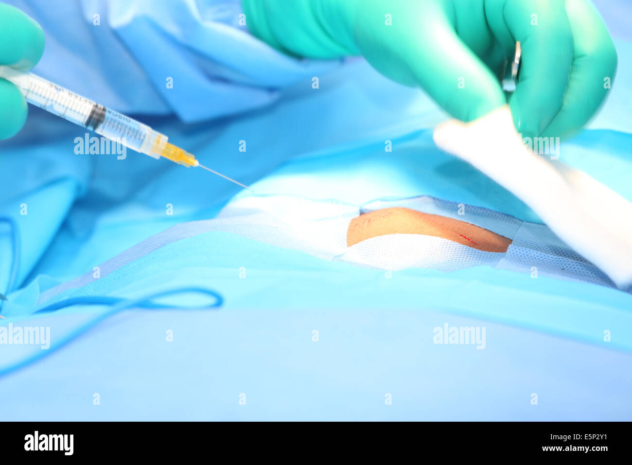 Doctor putting anesthesia in an open wound. Focus in the open wound ...
