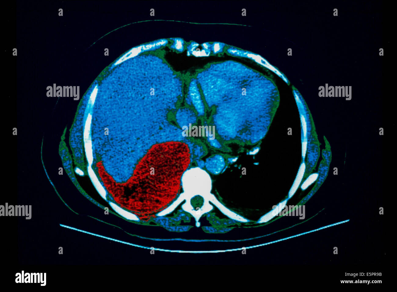 Axial Computed Tomography CT Scan Of The Abdomen Showing A Large Lung axial-computed-tomography-ct-scan-of-the-abdomen-showing-a-large-lung