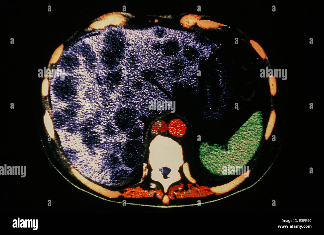 Axial computed Tomography (CT) scan through the abdomen showing secondary cancer of the liver ...