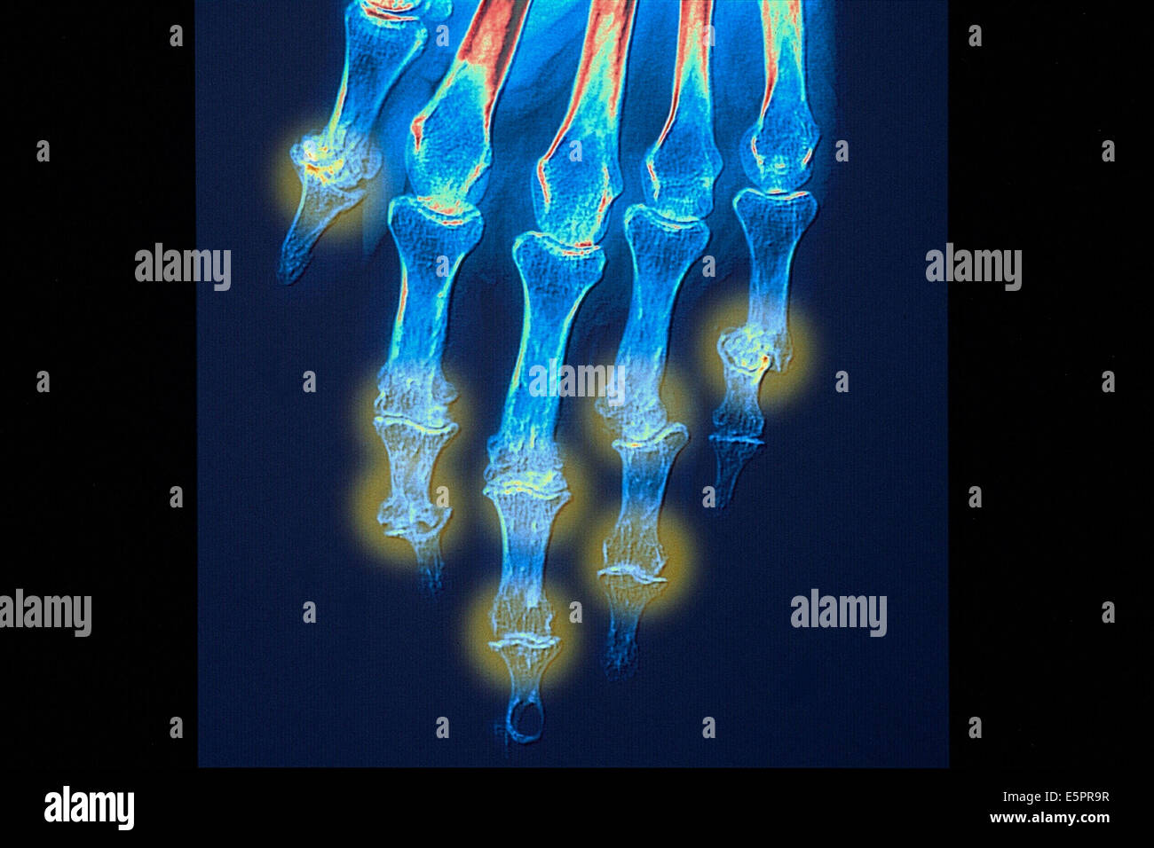X-ray of hand with Rheumatoid polyarthritis Stock Photo - Alamy