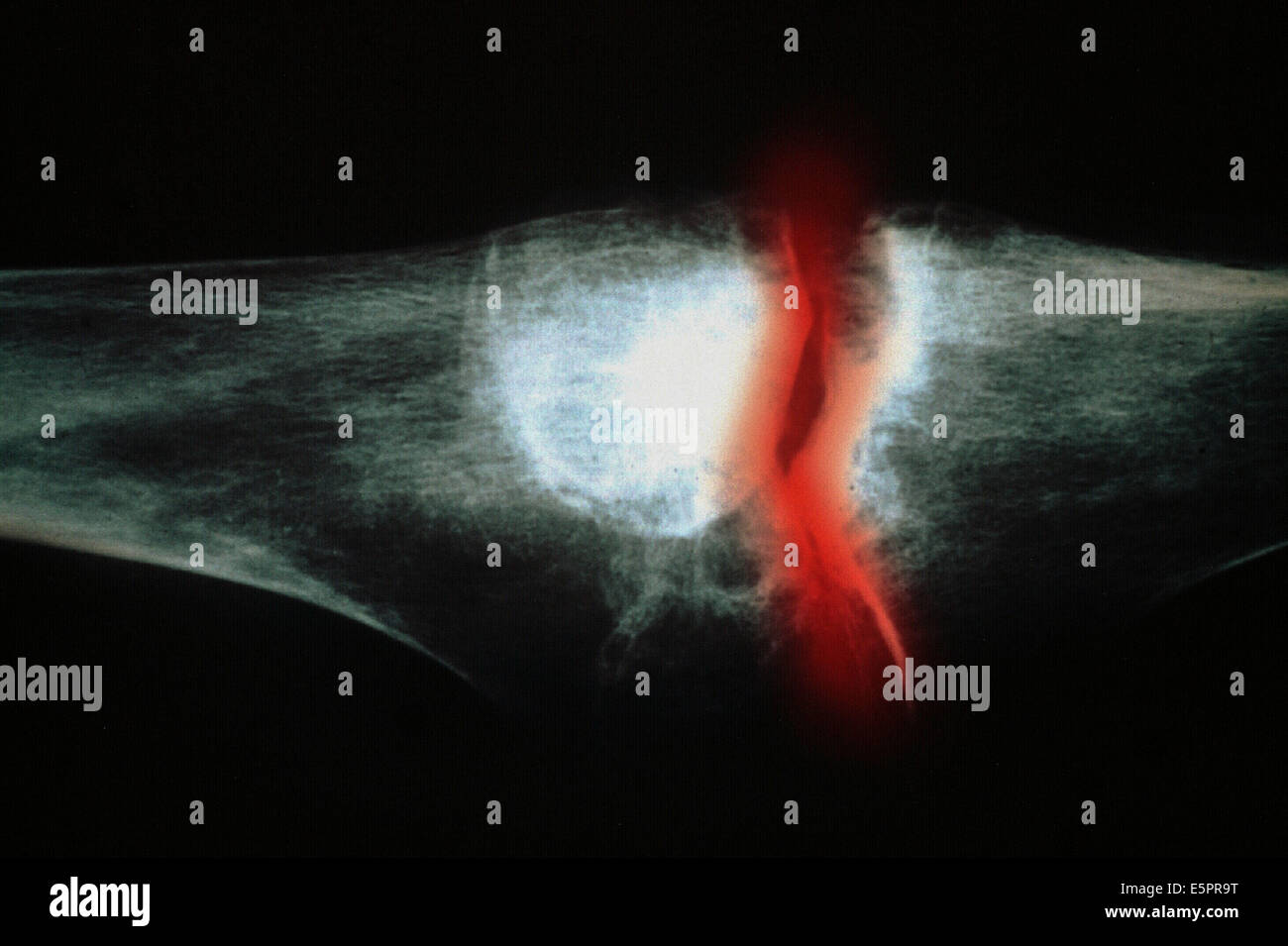 X-ray of the knee affected by chondrocalcinosis characterized by the ...