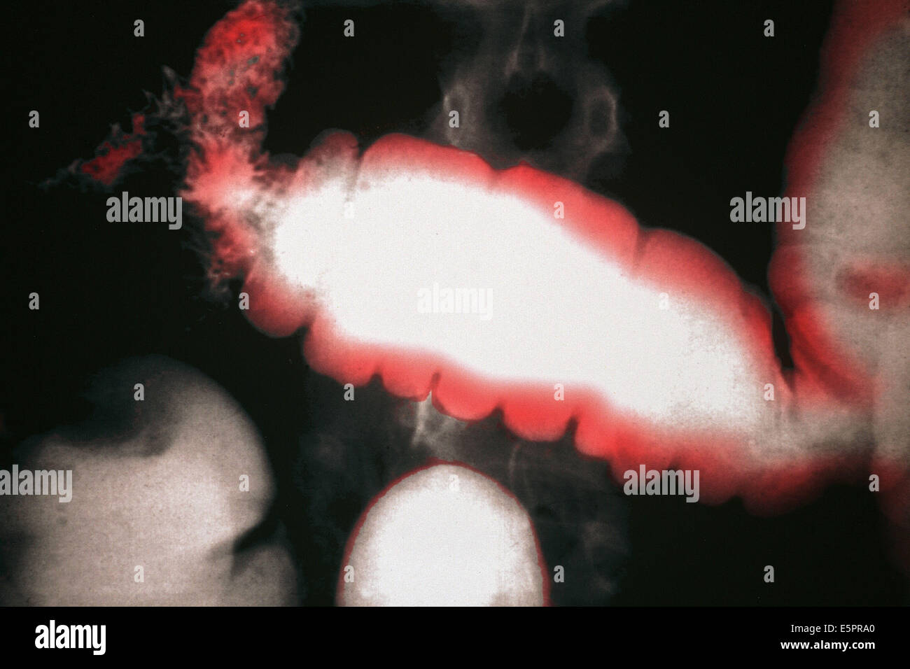 Barium enema large intestine High Resolution Stock Photography and ...