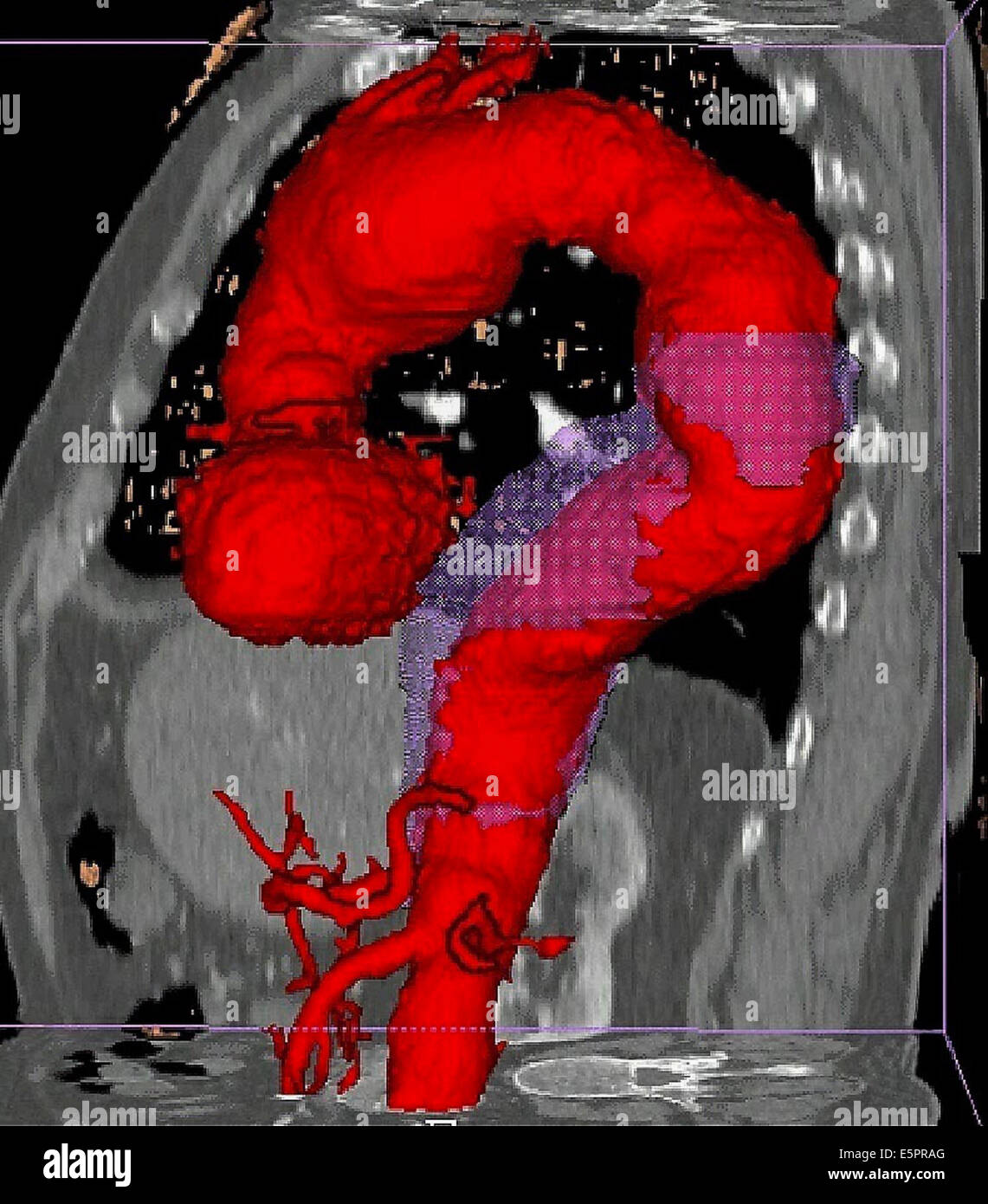Ascending aorta hi-res stock photography and images - Alamy