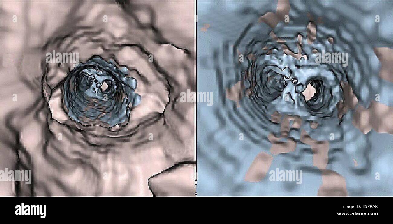 Three-dimensional computed tomographic inside (CT) scan view of ...