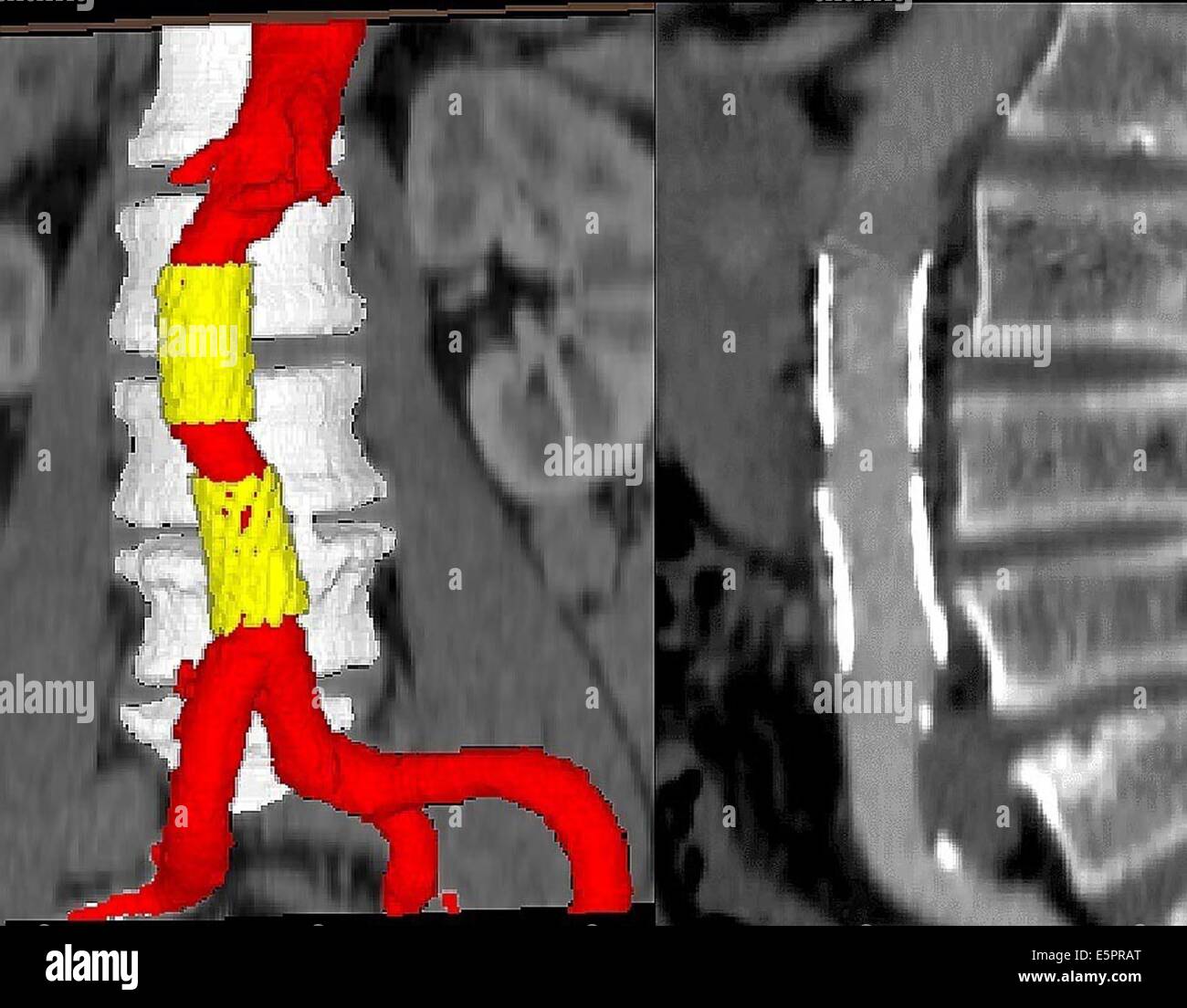 Ct of abdominal aorta hi-res stock photography and images - Alamy
