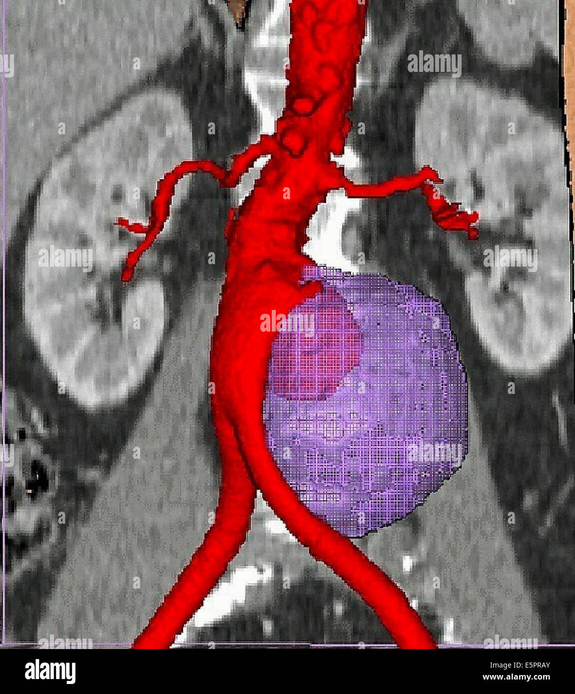 Abdominal aorta 3d ct scan hi-res stock photography and images - Alamy