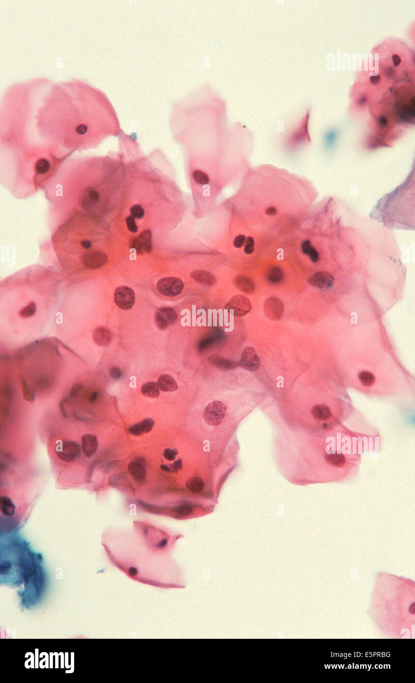 Light microscopy of cervical smear showing epithelial cells infected ...