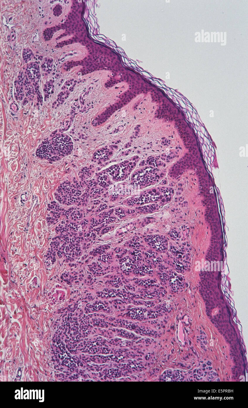 Naevus hi-res stock photography and images - Alamy