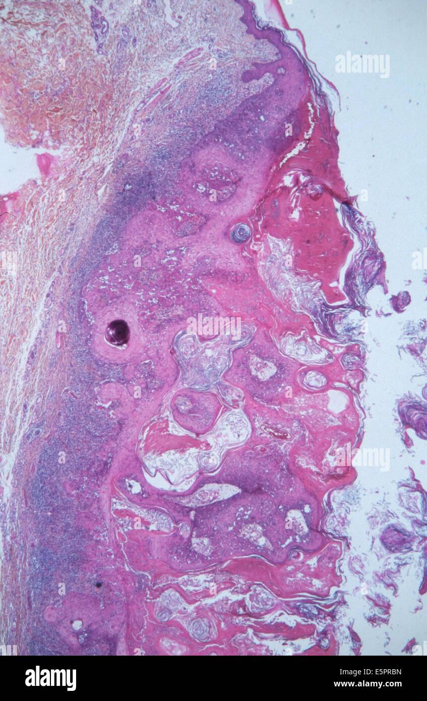 Keratoacanthoma, Skin precancerous lesion, Light microscopy Stock Photo ...
