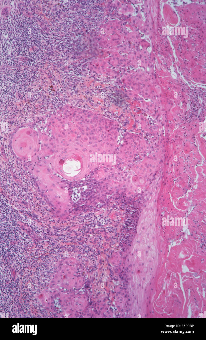 Keratoacanthoma hi-res stock photography and images - Alamy