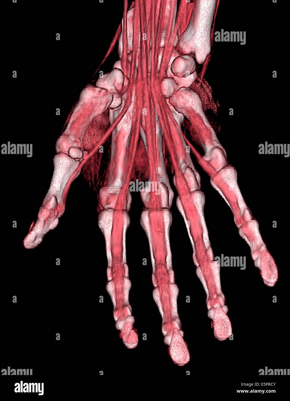 3D computed tomographic (CT) scan reconstruction of the left hand ...