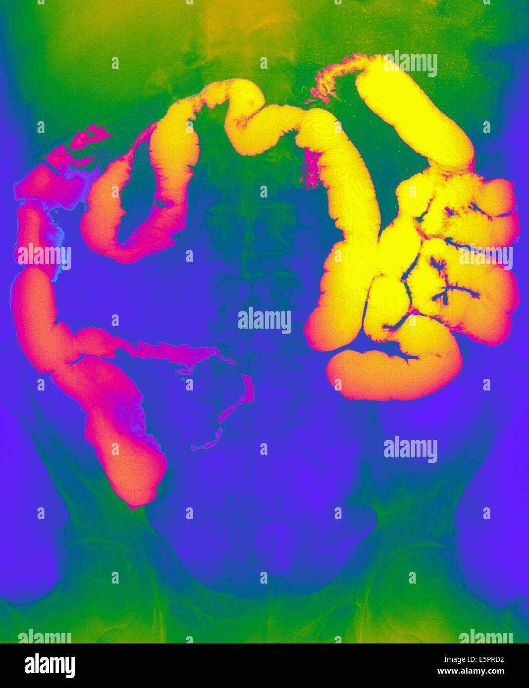 X-ray of the intestines of a patient with Crohn's disease Stock Photo ...
