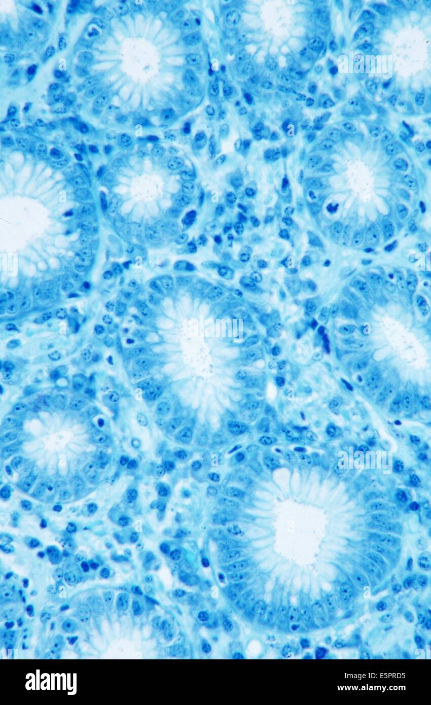 Infection of stomach lining by Helicobacter pylori bacteria causing ...