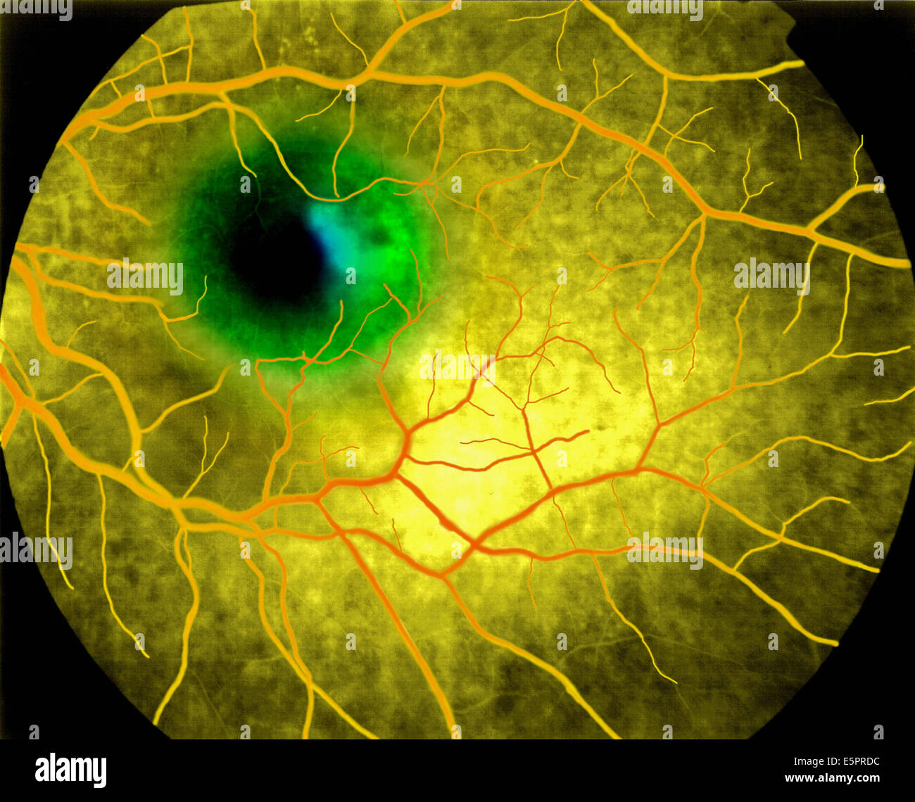 Eye angiography of an Age-Related Macular Degeneration (ARMD Stock ...