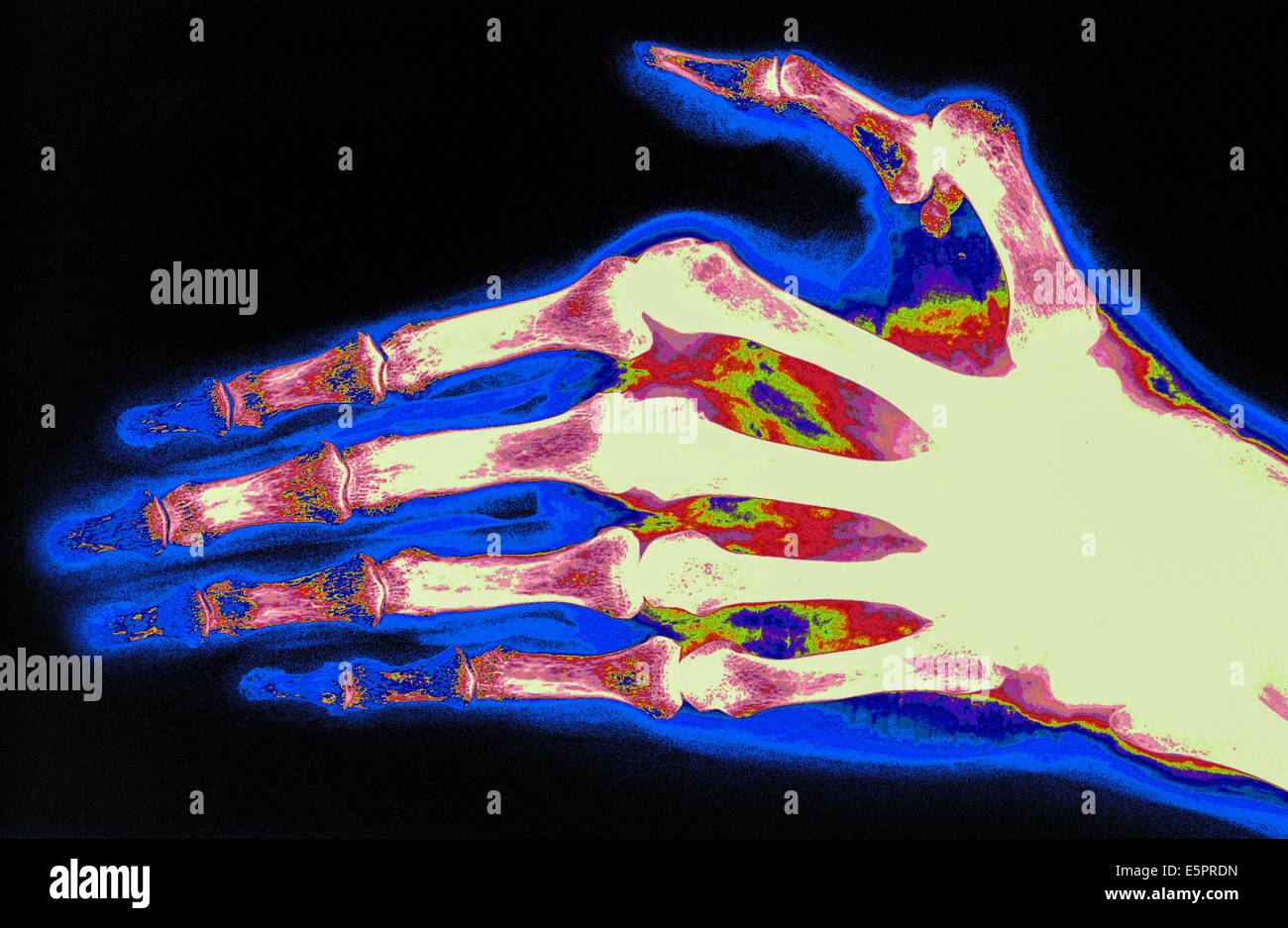 X-ray of hand with Rheumatoid polyarthritis Stock Photo - Alamy