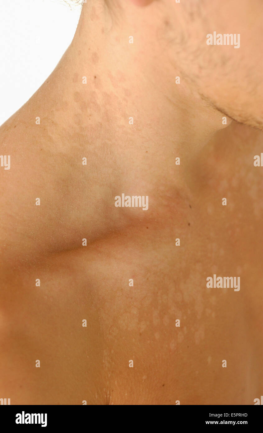 Tinea versicolor hi-res stock photography and images - Alamy