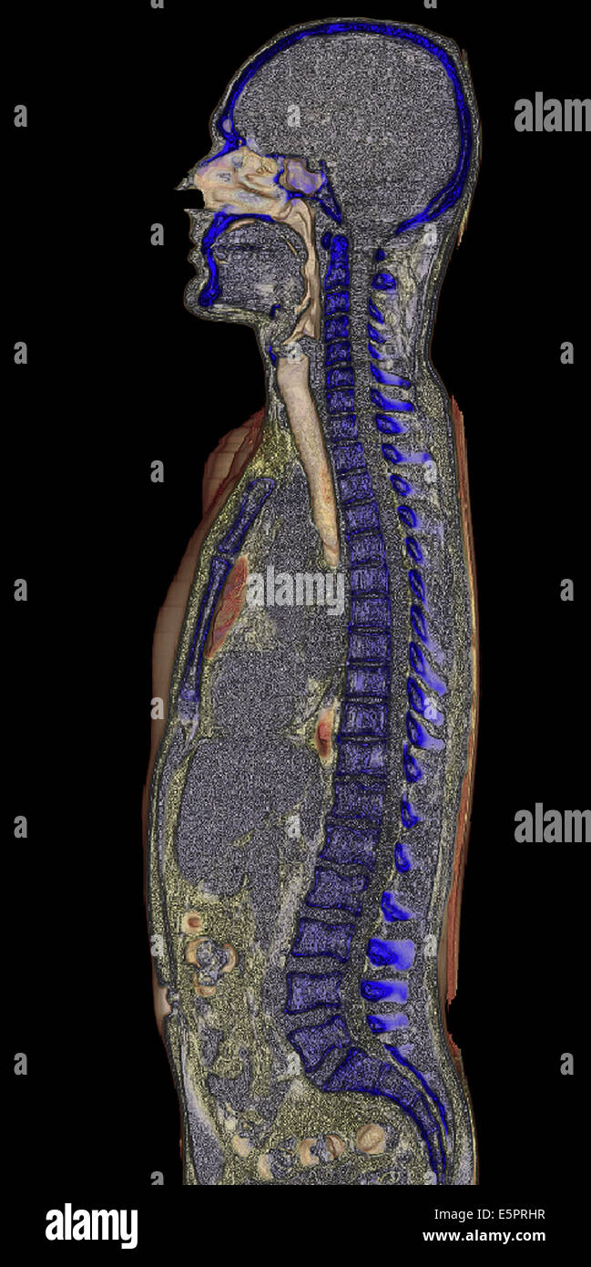 3D computed tomographic (CT) scan reconstruction (longitudinal side ...