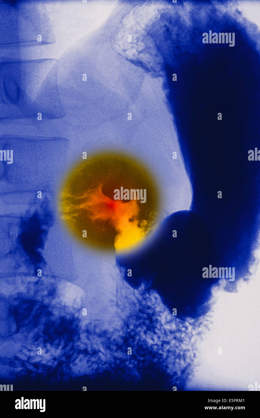 X Ray Barium Side Effects