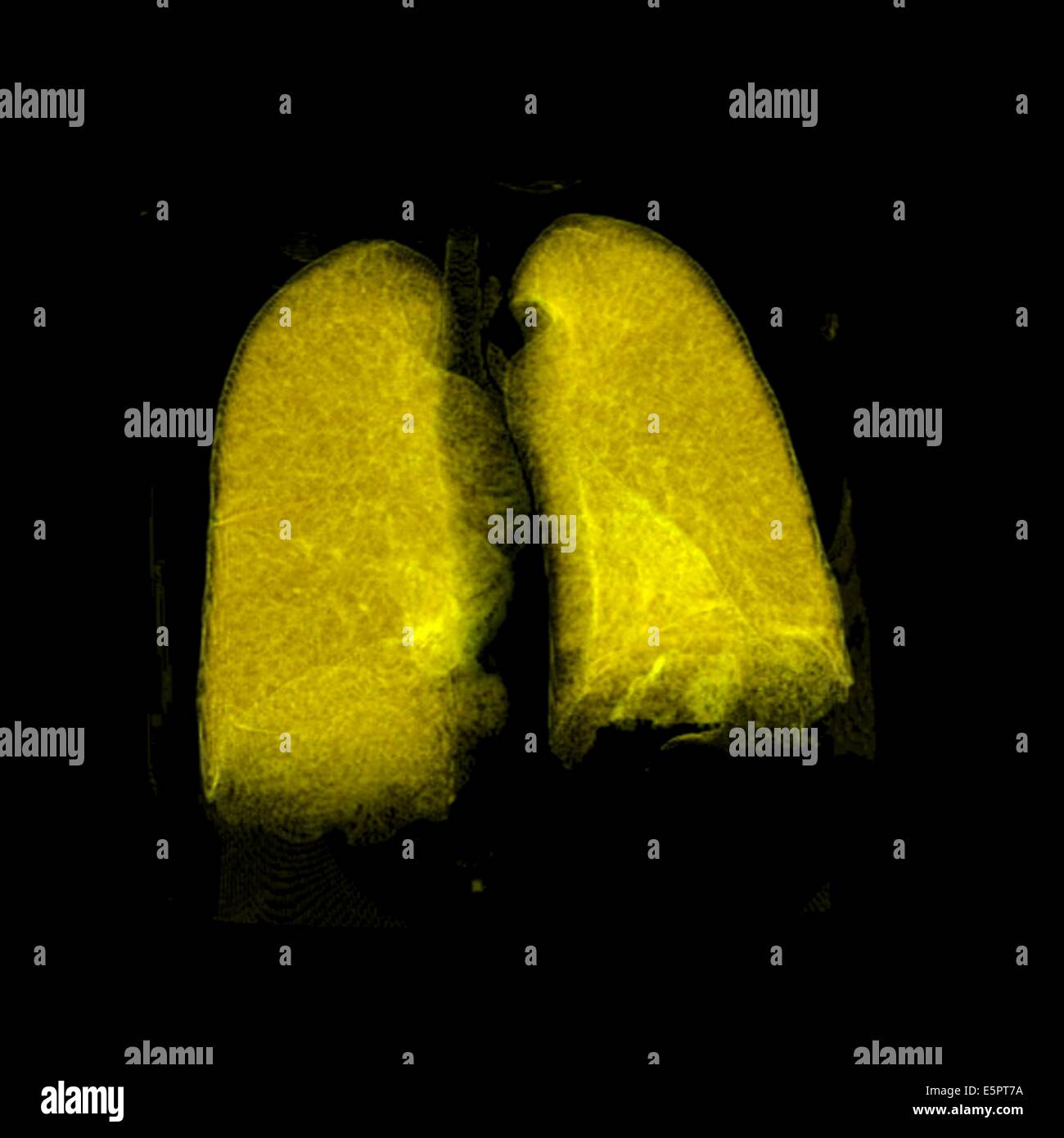 Three-dimensional computed tomographic reconstruction of healthy lungs ...