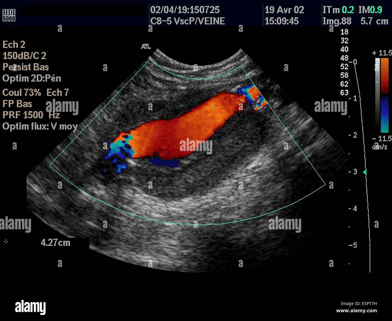 Color Doppler ultrasound scan of an aneurysm of the abdominal aorta ... Color Doppler ultrasound scan of an aneurysm of the abdominal aorta ...