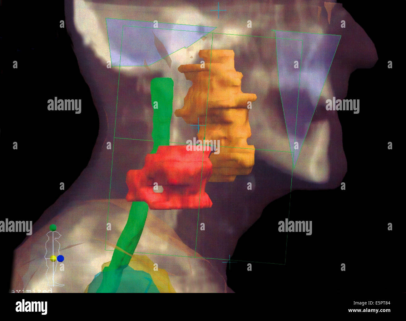 Three-dimensional Computed Tomograpgy (CT) scan of the neck showing ...