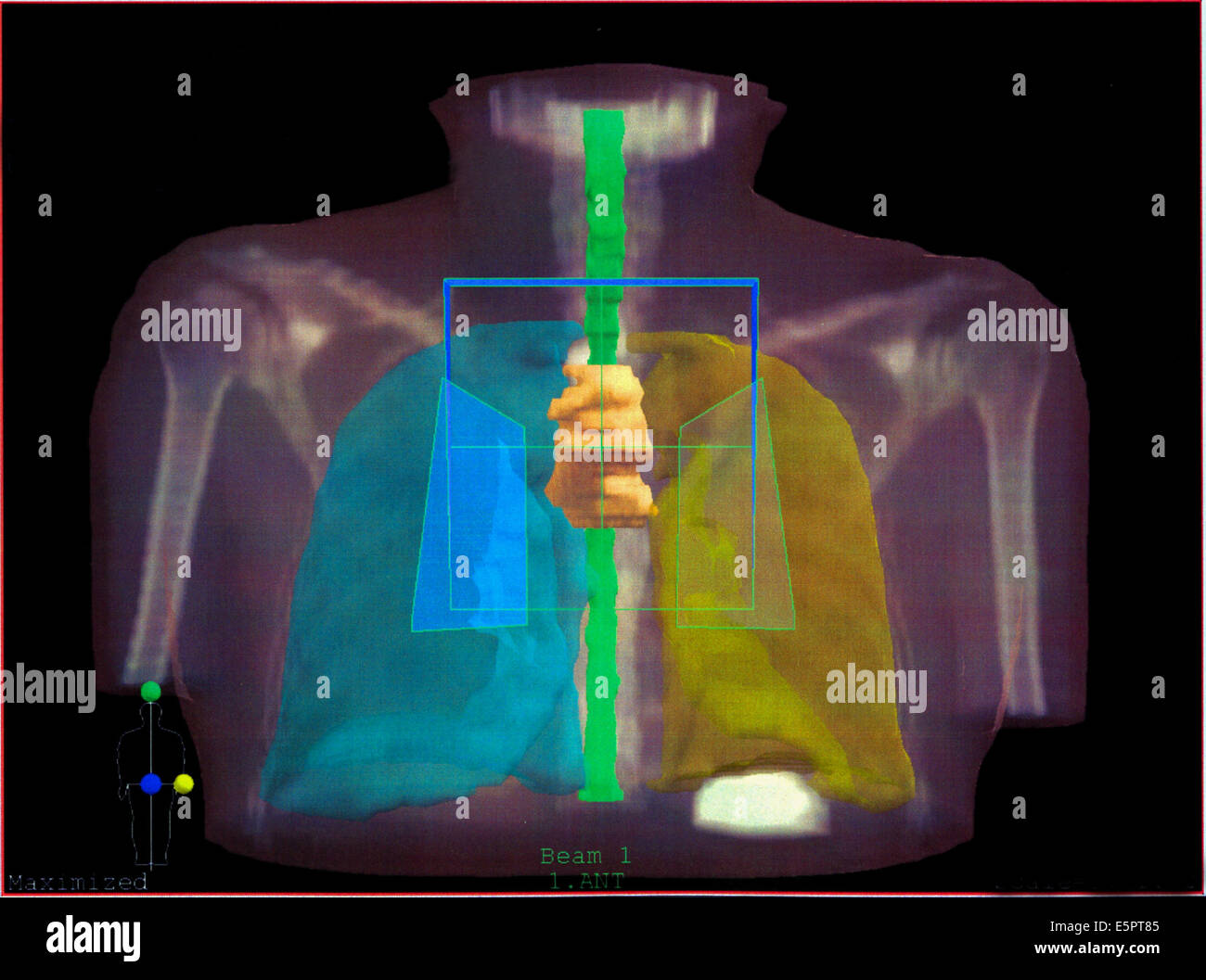 Radiotherapy chest hi-res stock photography and images - Alamy