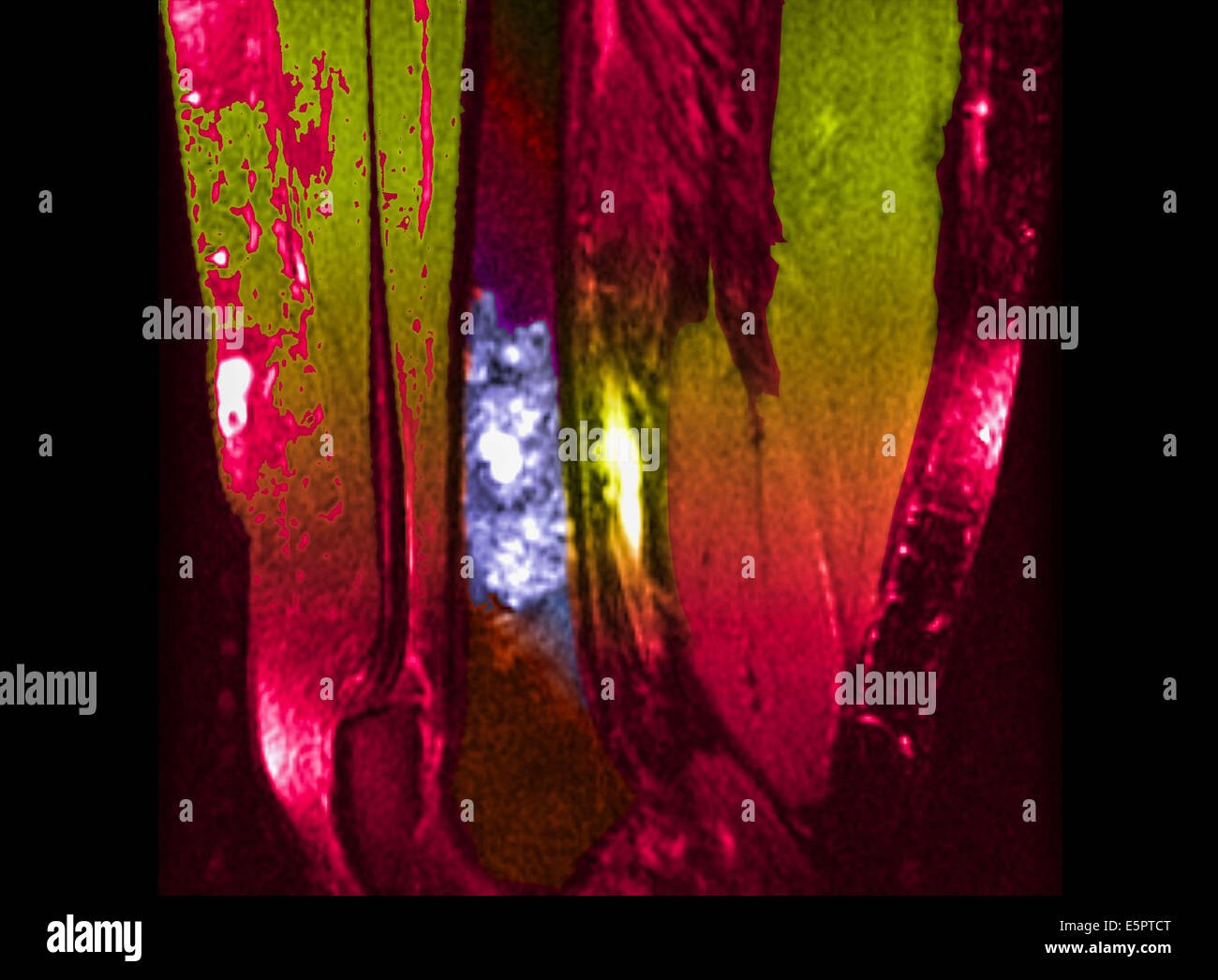 Color enhanced Ct scan of the leg showing a chondroma of the femur ...