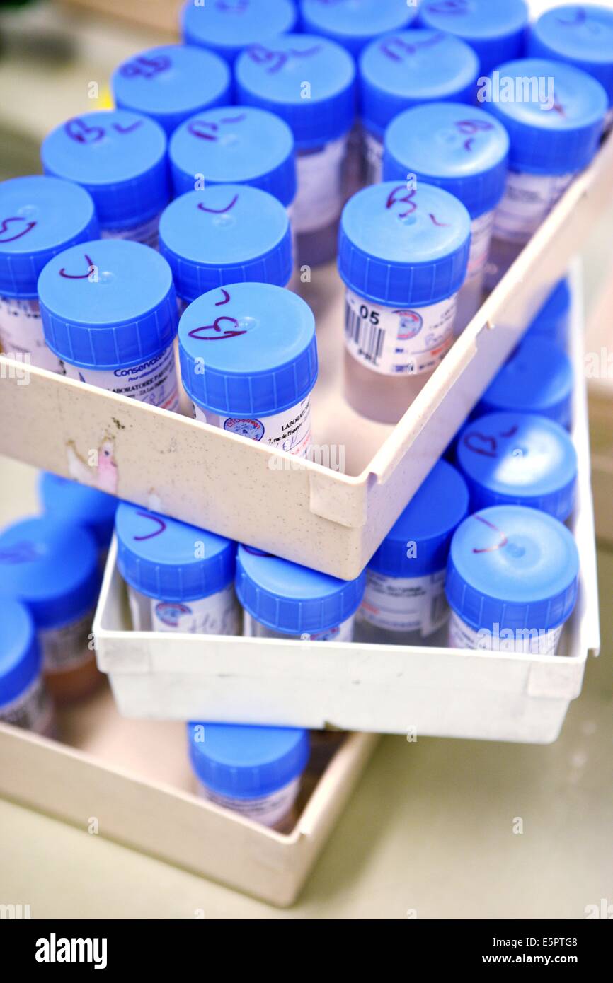 Sampling of cervical smears in liquid phase collected at the laboratory ...