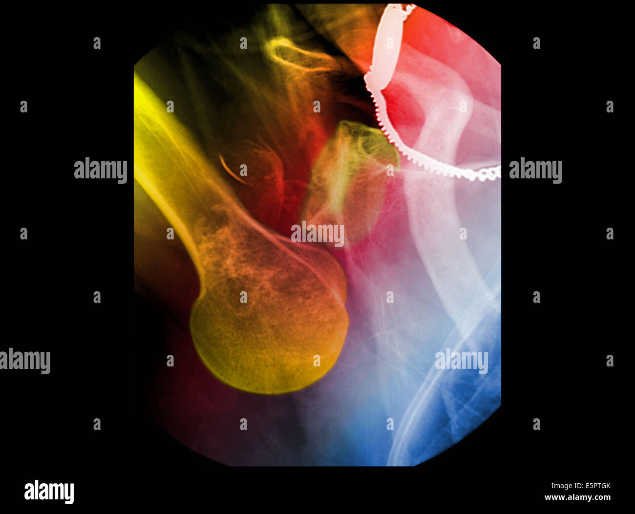Dislocation shoulder x ray hi-res stock photography and images - Alamy