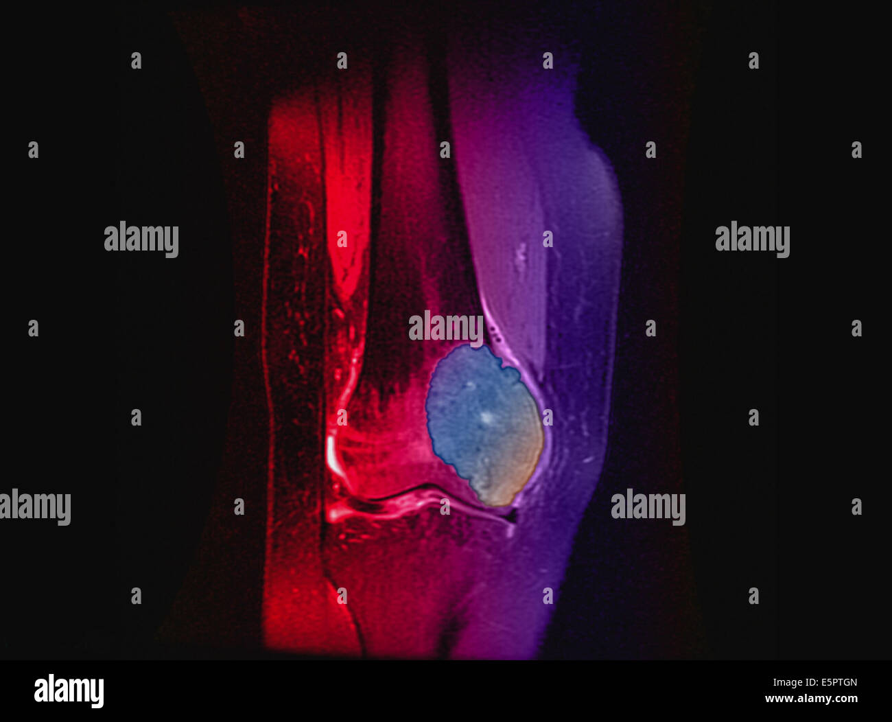 Front view Magnetic Resonance Image (MRI) of the knee showing a giant ...