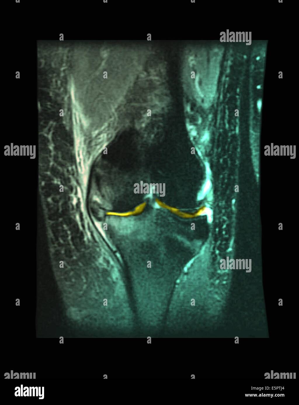 Magnetic Resonance Therapy For Knee Osteoarthritis at Sean Freeleagus blog