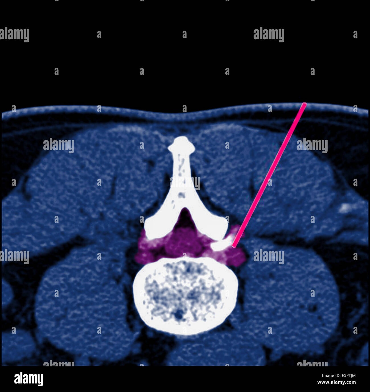 Color enhanced axial Computed Tomography (CT) scan of a lumbar vertebra ...