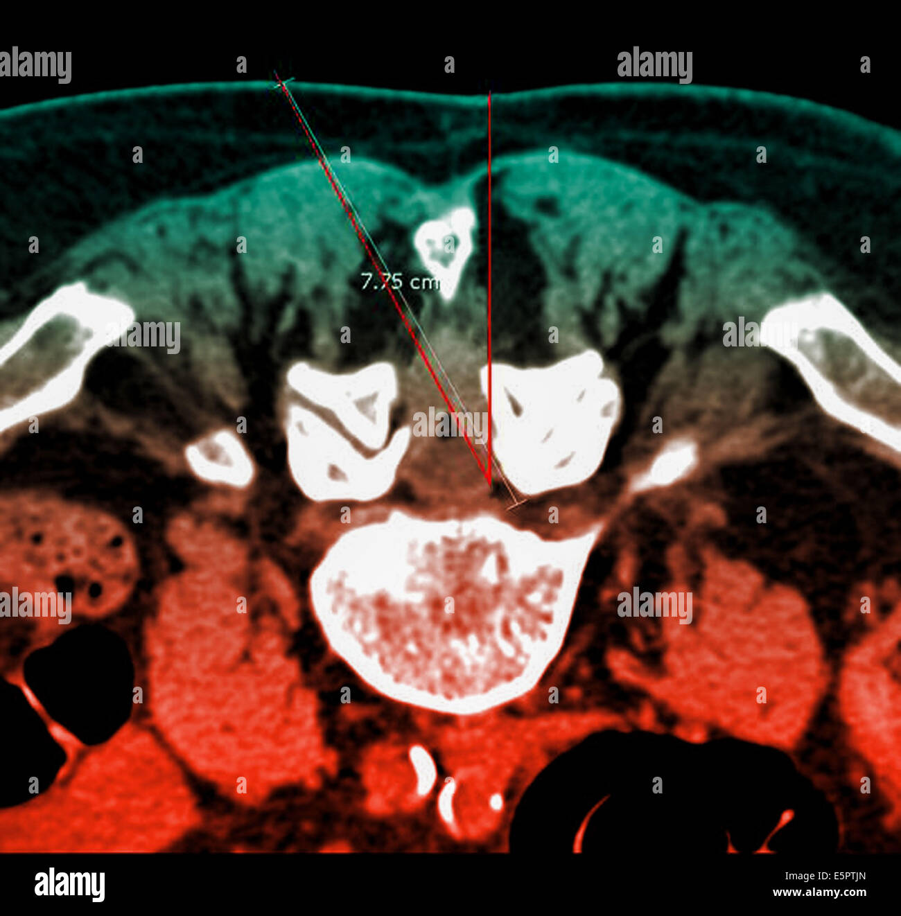 Color enhanced axial Computed Tomography (CT) scan of a lumbar vertebra ...