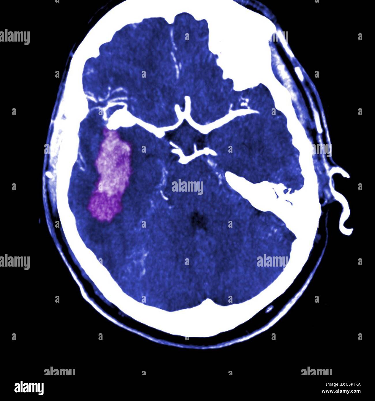 Cerebral hemorrhage brain scan hi-res stock photography and images - Alamy