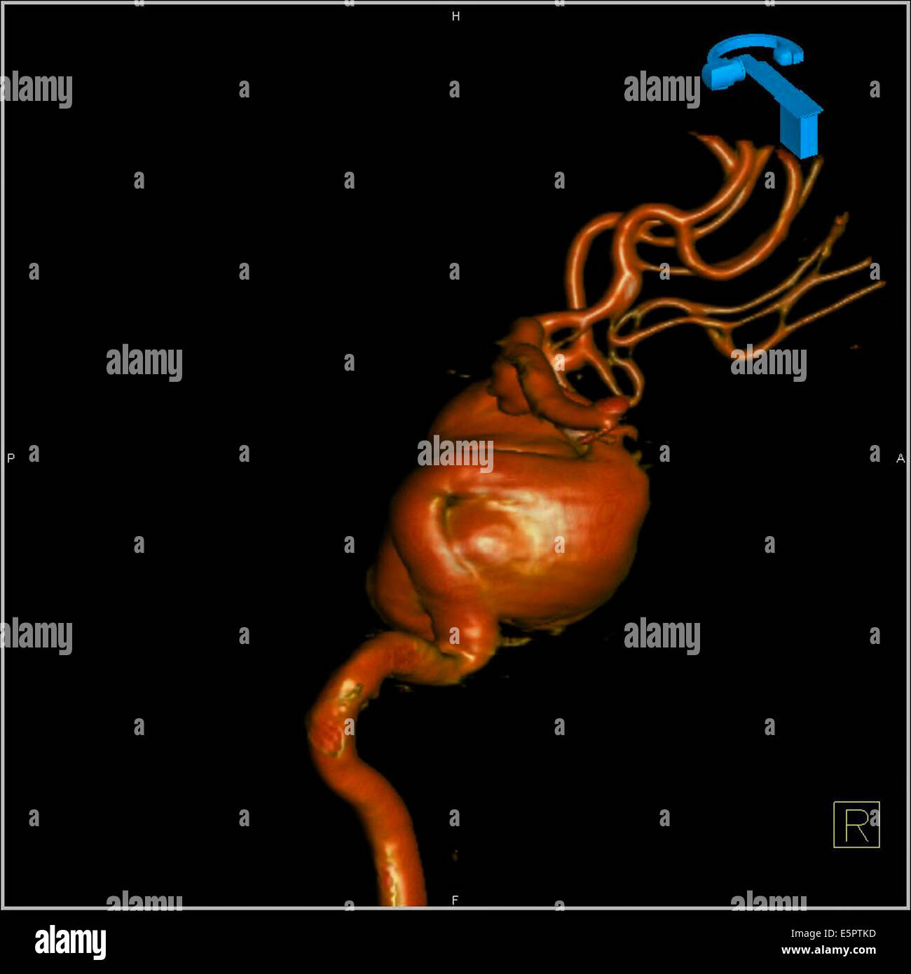 3D Computed Tomography (CT) scan reconstruction of a giant aneurysm of ... 3D Computed Tomography (CT) scan reconstruction of a giant aneurysm of ...