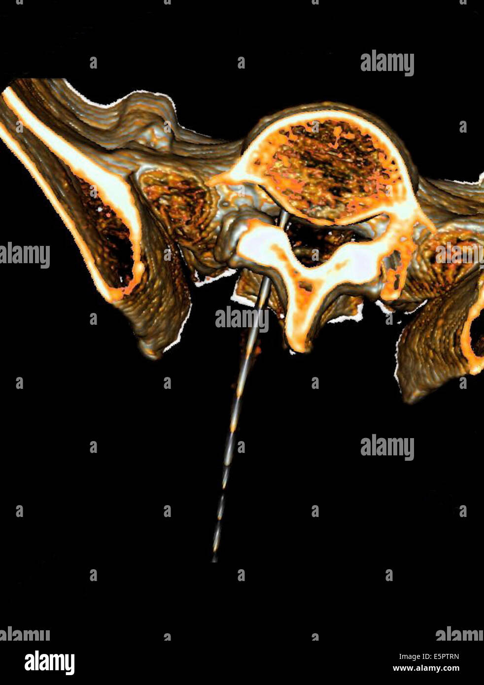 Lumbar Incision High Resolution Stock Photography and Images - Alamy
